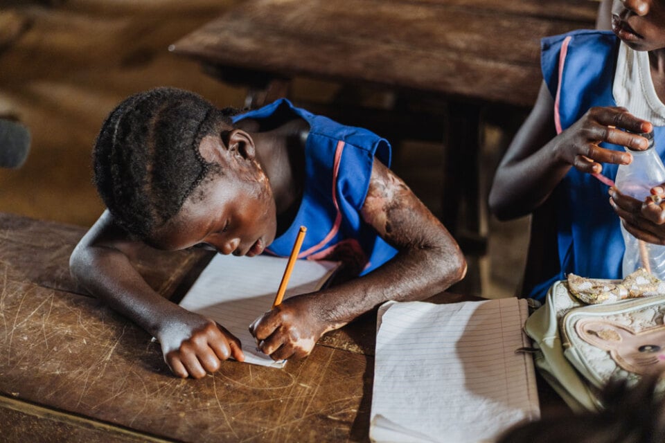 mercy-ships-patient-stories-plastics-musu-2 | Mercy Ships